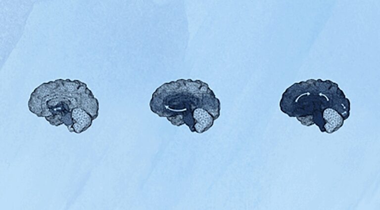 What Parts of the Brain Does Alzheimer’s Affect? | Being Patient